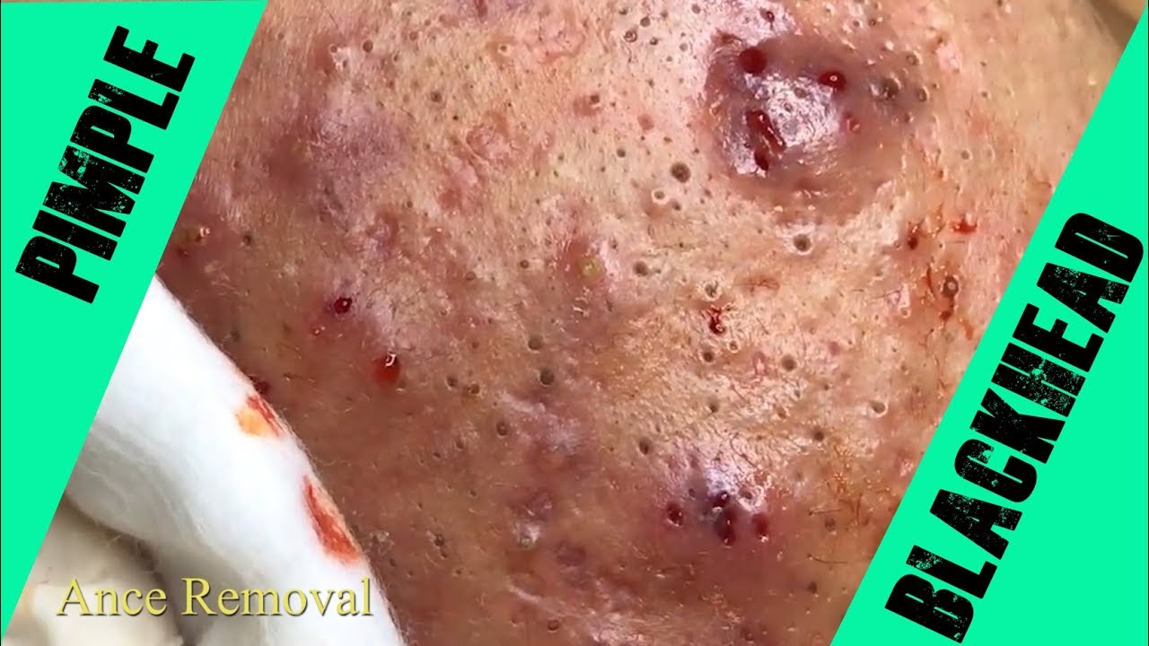 Blackheads Infected Cystic Acne Removal On Face Part 02 Blackhead Blackheads Infected Cystic Acne Removal On Face Part 02 Blackhead